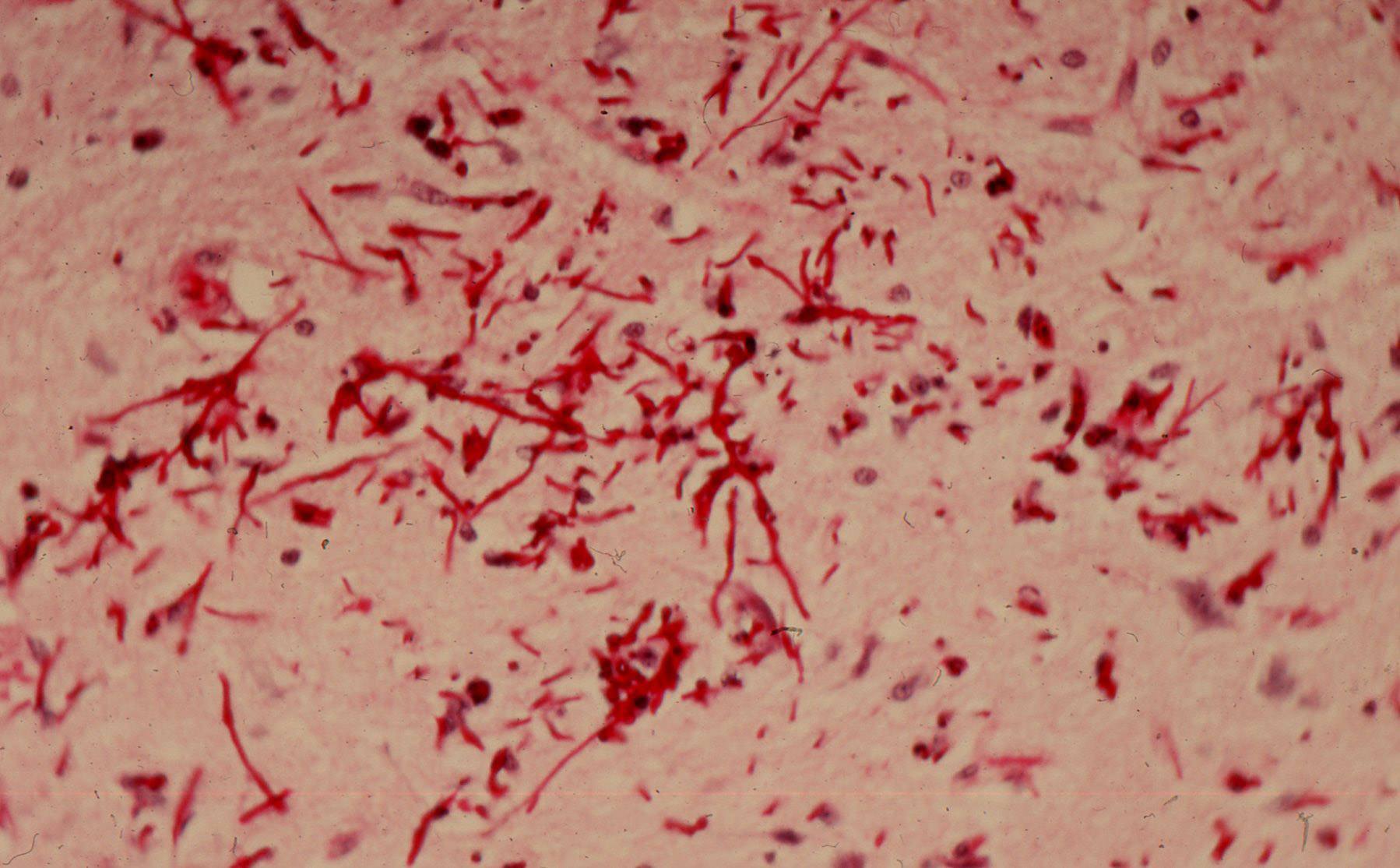Candida Overgrowth Symptoms